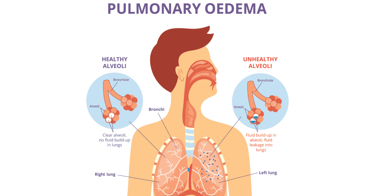 Pulmonary-Oedema---Header | Eakin Respiratory