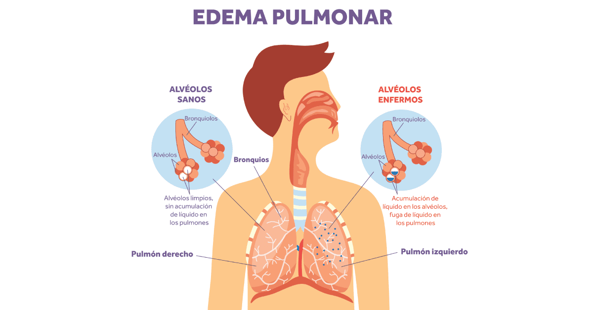 Líquido En Los Pulmones: Causas Y Tratamiento | Eakin Respiratory