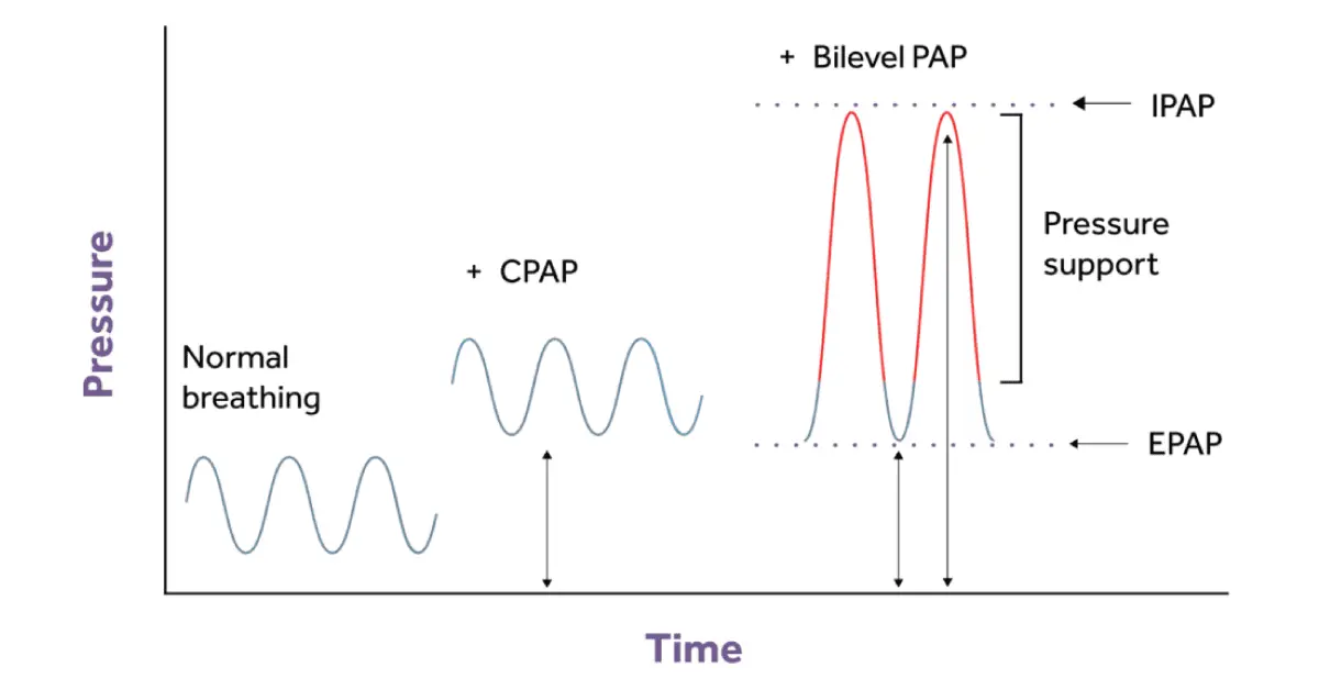 The Differences Between CPAP And Bilevel PAP | Inspire Blog