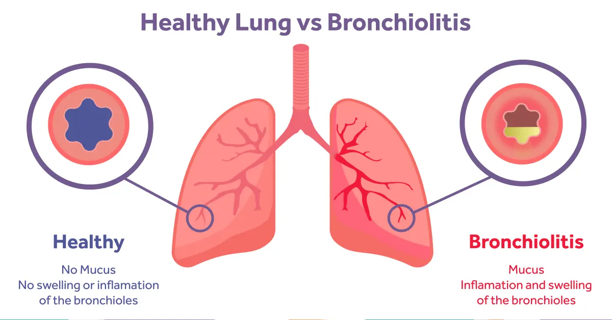 Healthy Lung Vs Bronch | Eakin Respiratory