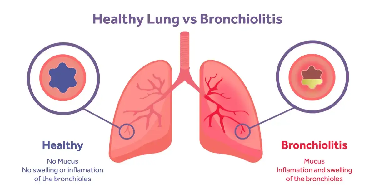 Management Of Bronchiolitis, What Does The Evidence Say? | Eakin ...