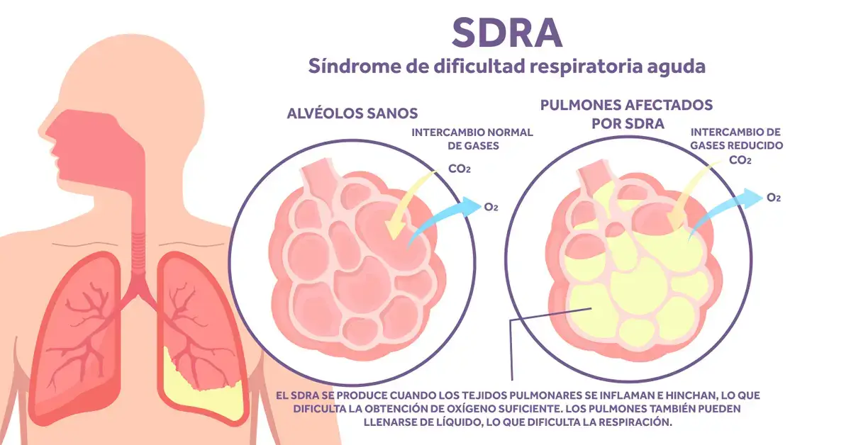Signos Y Síntomas De Dificultad Respiratoria