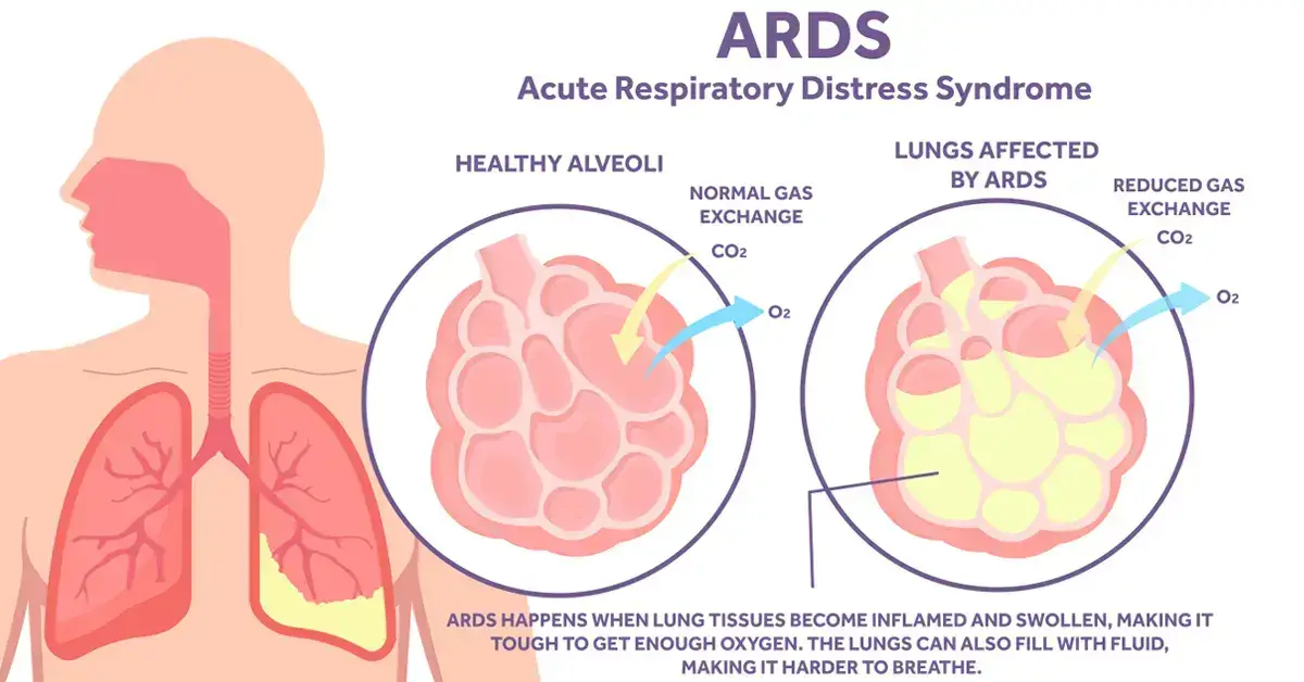 The Critical Care Practitioners Guide To Ards Traits And Treatment Eakin Respiratory